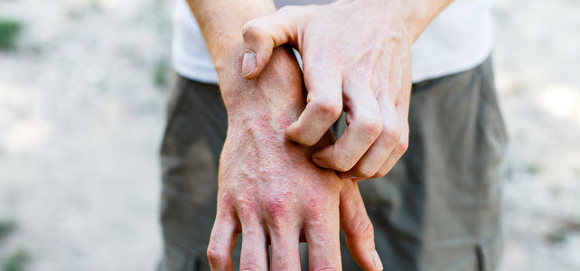 Atopische Dermatitis: Neue Erkenntnisse vom EADV 2022